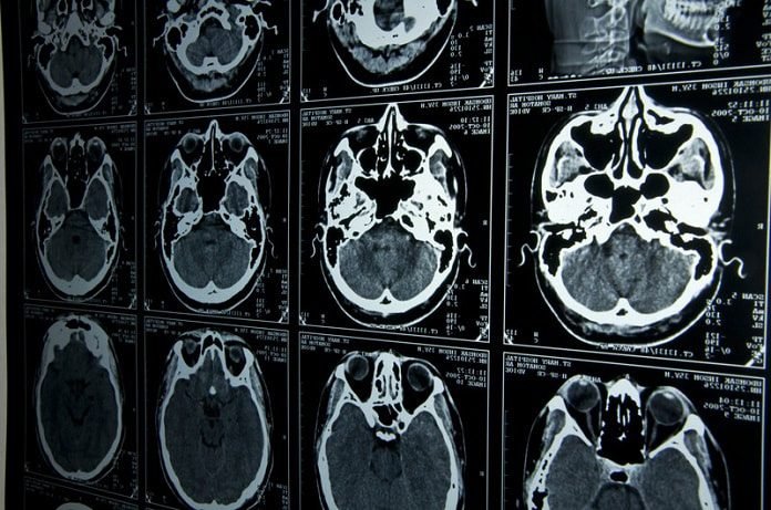 MRI May Predict Outcomes of Depression Treatment | Medical News Bulletin